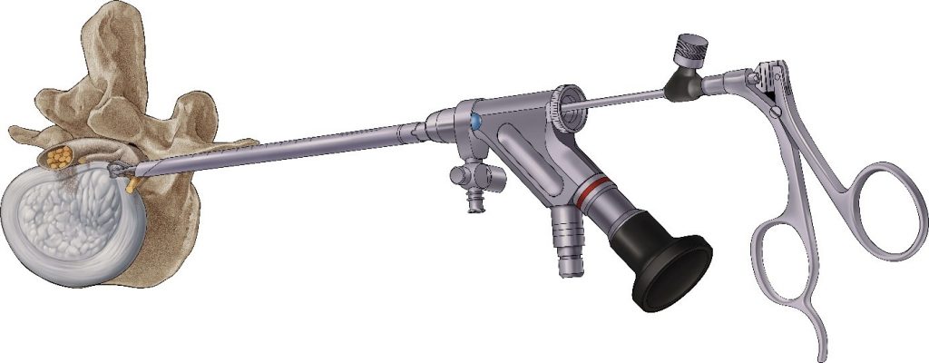 Bandscheibenvorfall HWS/LWS/BWS - Klinik Sansoucci Potsdam